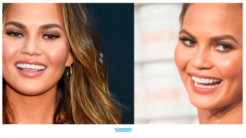 40 Celebrities With Veneers, Before & After Transformations + Costs ...