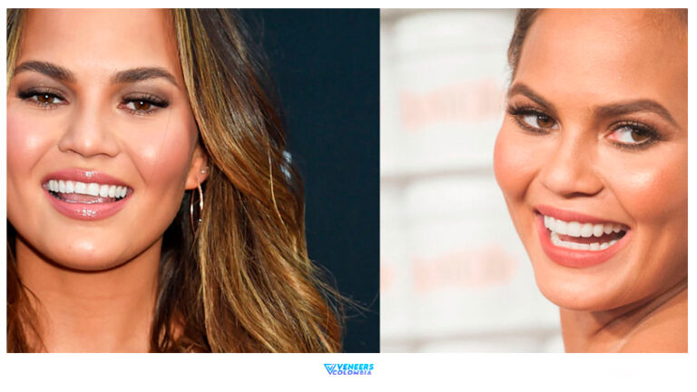 40 Celebrities With Veneers, Before & After Transformations + Costs ...