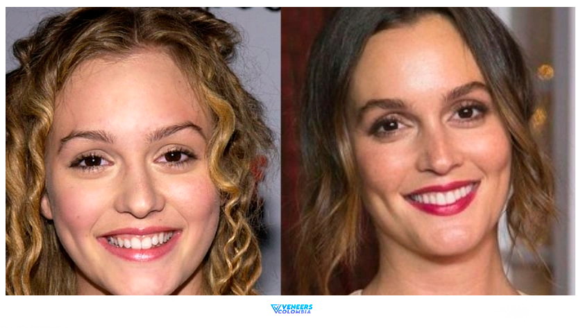 40 Celebrities With Veneers, Before & After Transformations + Costs ...
