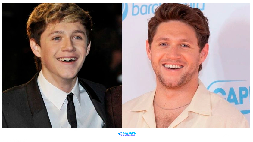 40 Celebrities With Veneers, Before & After Transformations + Costs ...