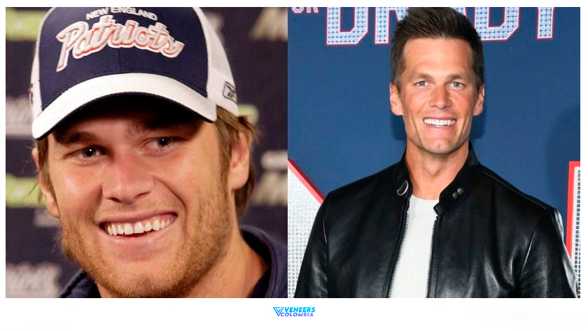40 Celebrities With Veneers, Before & After Transformations + Costs ...