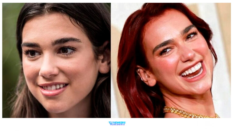 40 Celebrities With Veneers, Before & After Transformations + Costs ...