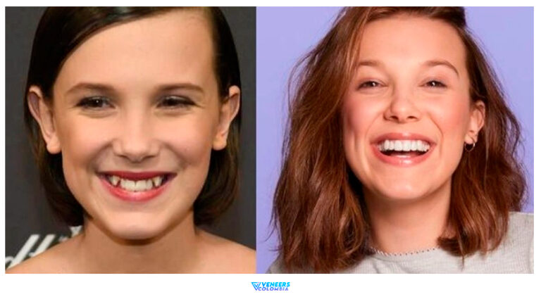 40 Celebrities With Veneers, Before & After Transformations + Costs ...