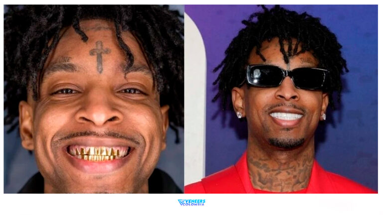 40 Celebrities With Veneers, Before & After Transformations + Costs ...