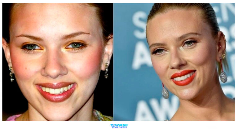 40 Celebrities With Veneers, Before & After Transformations + Costs ...