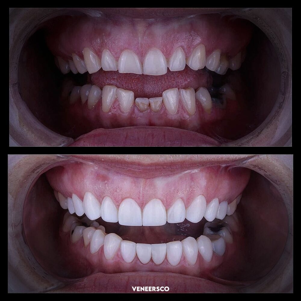 Professional Teeth Whitening in Medellín, Colombia: 2025 Complete Guide ...