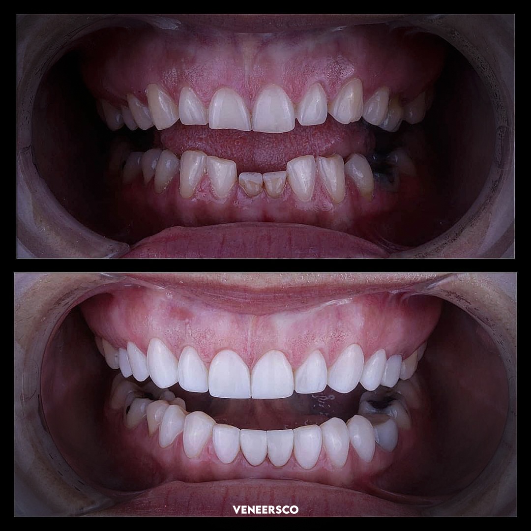 Professional Teeth Whitening in Medellín, Colombia: 2025 Complete Guide ...