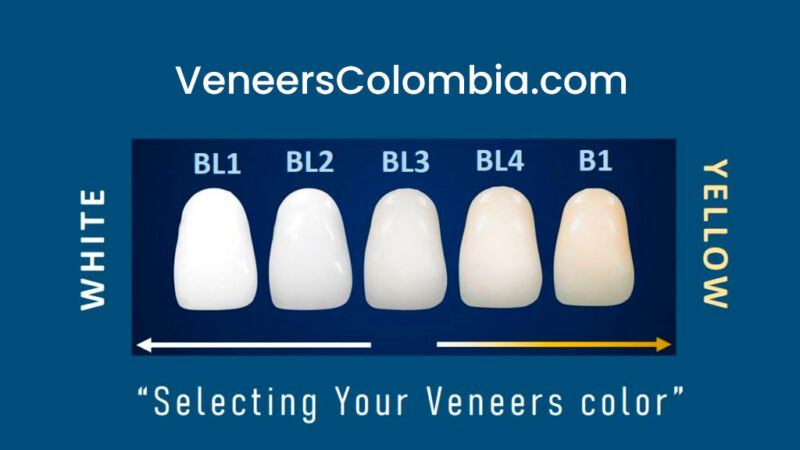 Best Veneer Color Shades 2025: BL1 vs BL2 Comparison