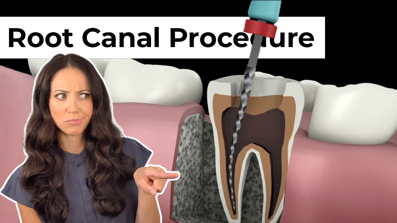 Root Canal Procedure Explained: Step-by-Step Guide to Tooth Repair